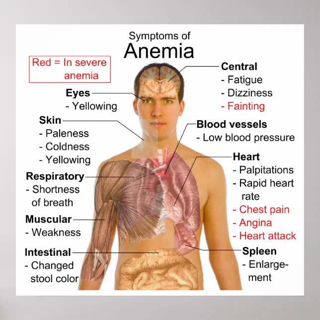 Póster Sintomas Gráfico da Anemia da Doença Sanguínea | Zazzle Portugal